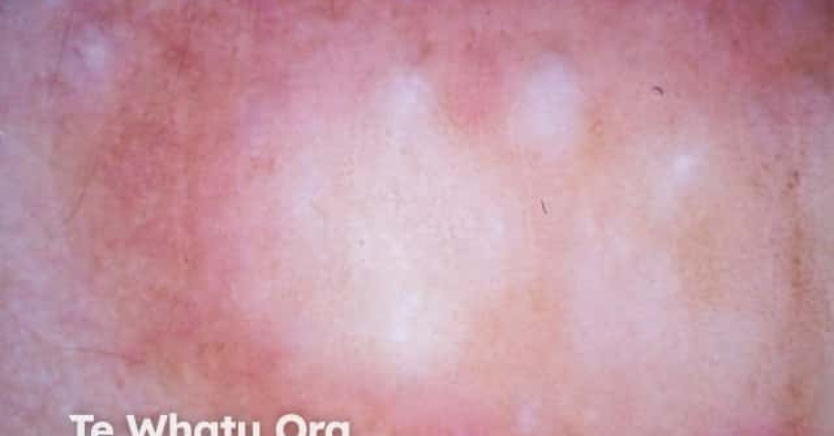 Keloid scar image