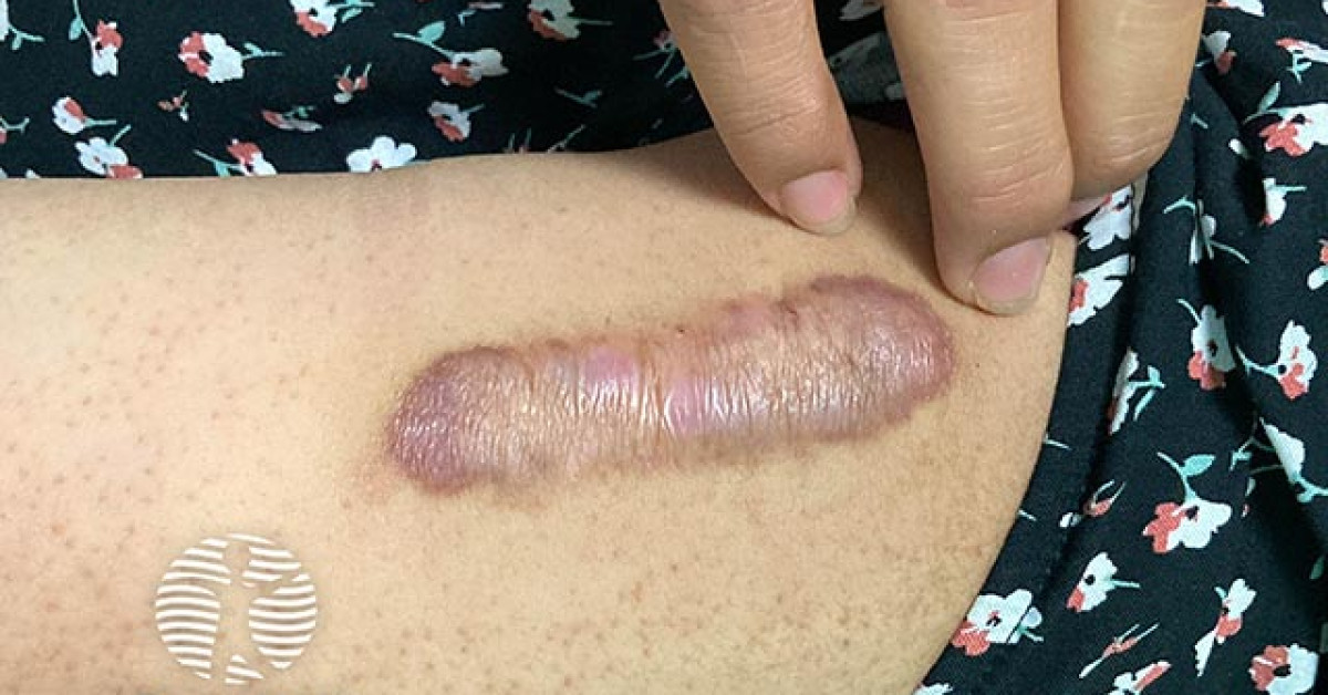 Keloid scar image