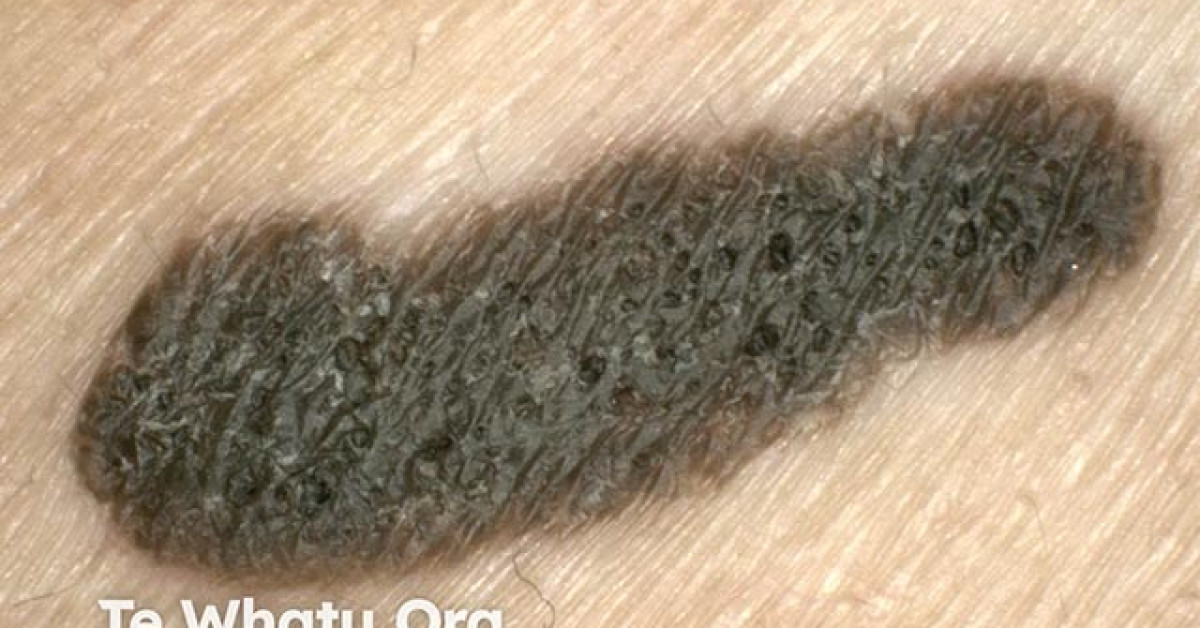 Keratinocytic epidermal naevus image