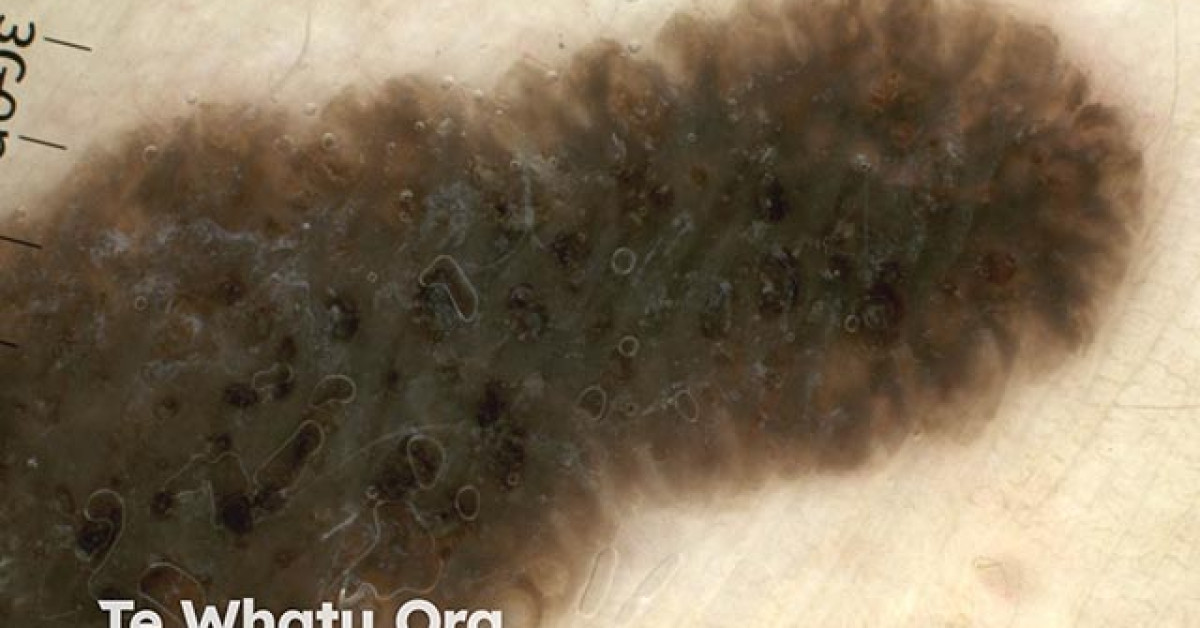 Keratinocytic epidermal naevus image
