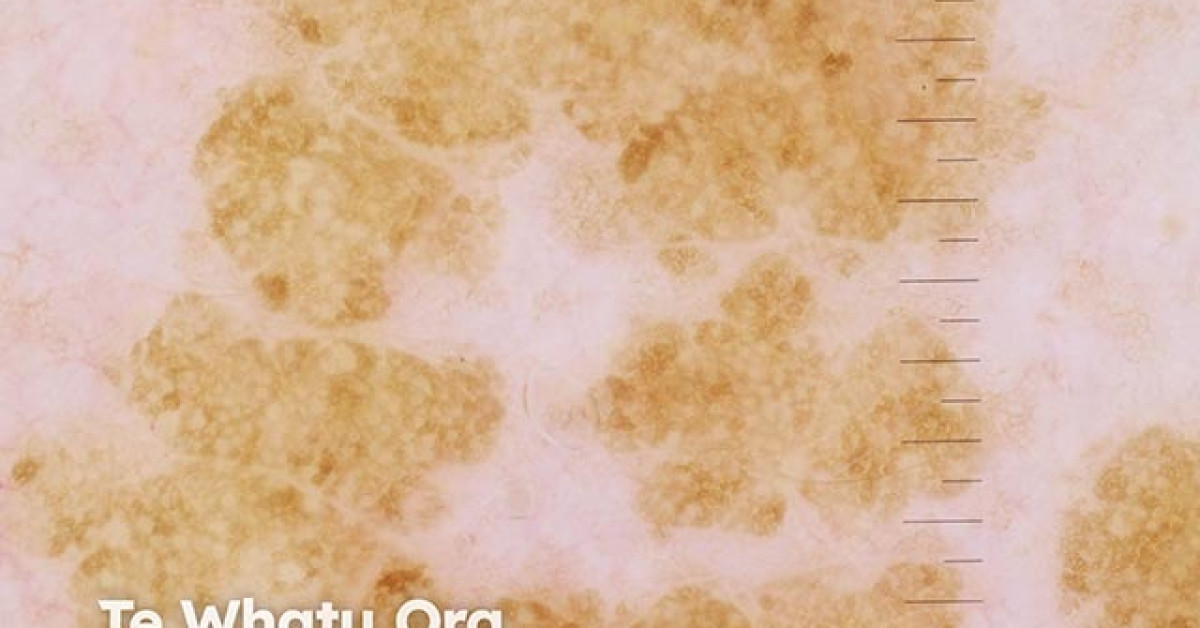 Keratinocytic epidermal naevus image
