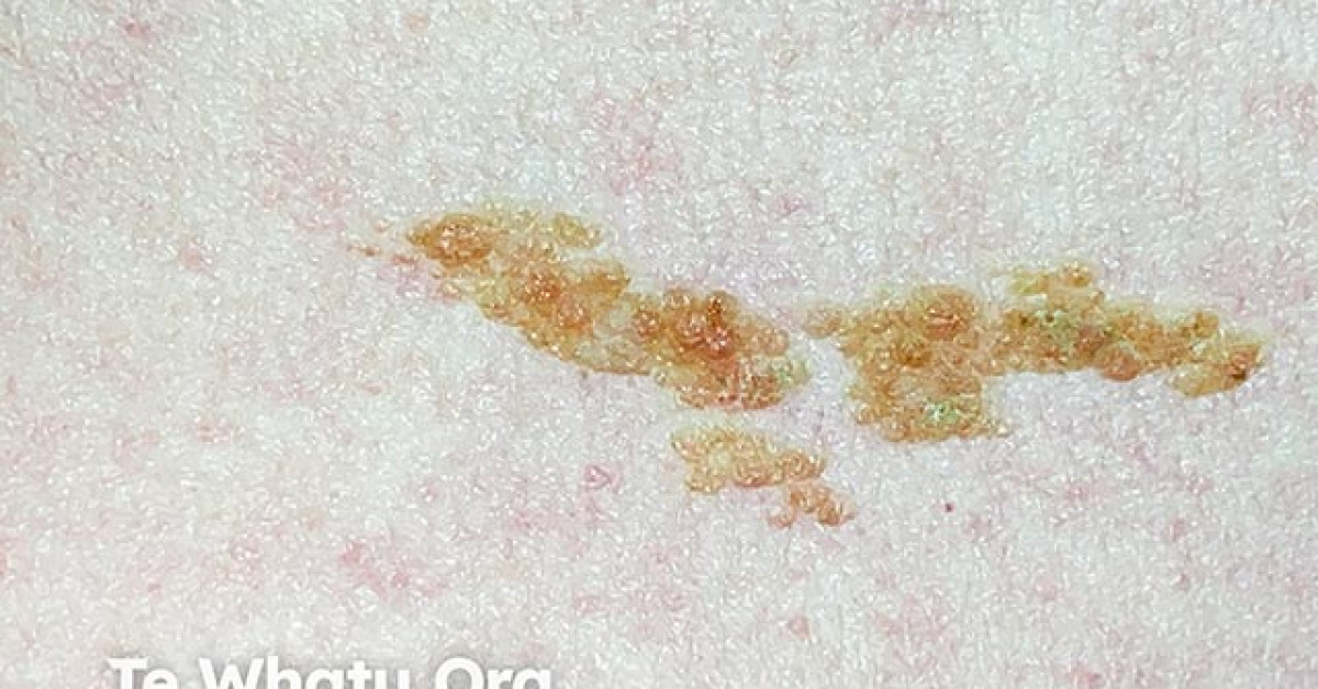 Keratinocytic epidermal naevus image