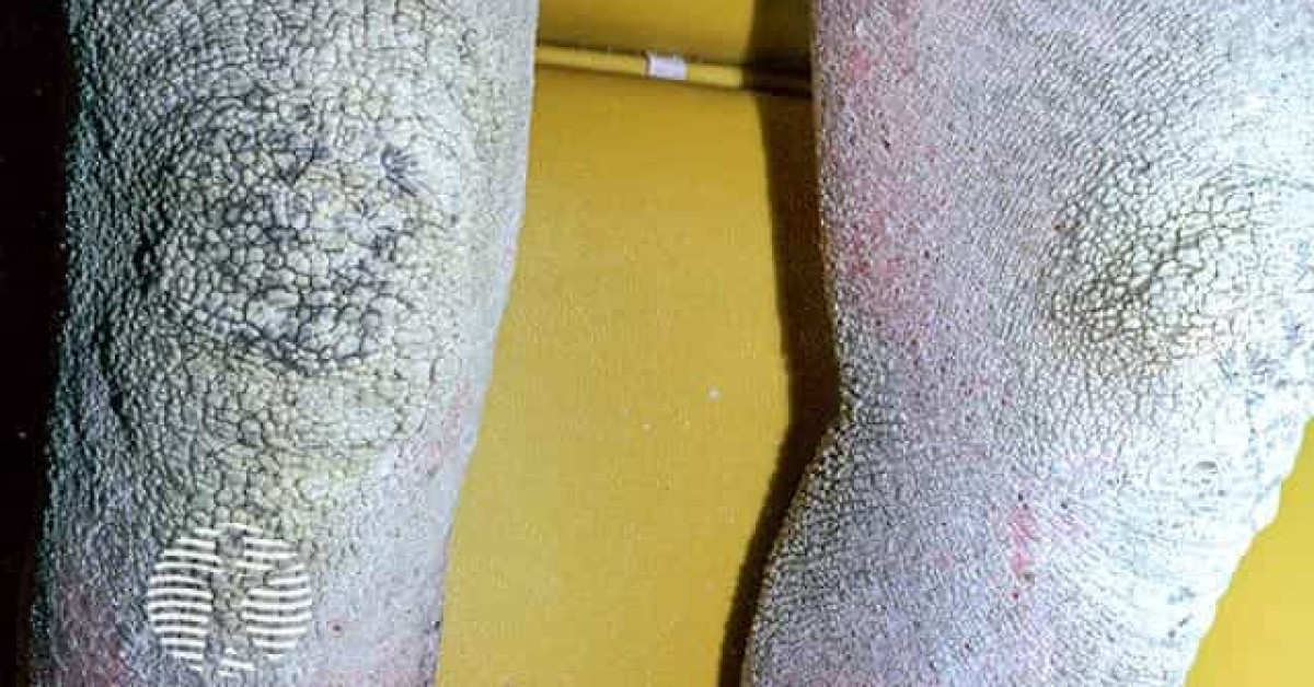 Keratinopathic ichthyosis image