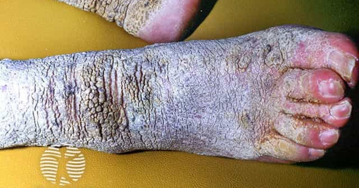 Keratinopathic ichthyosis image