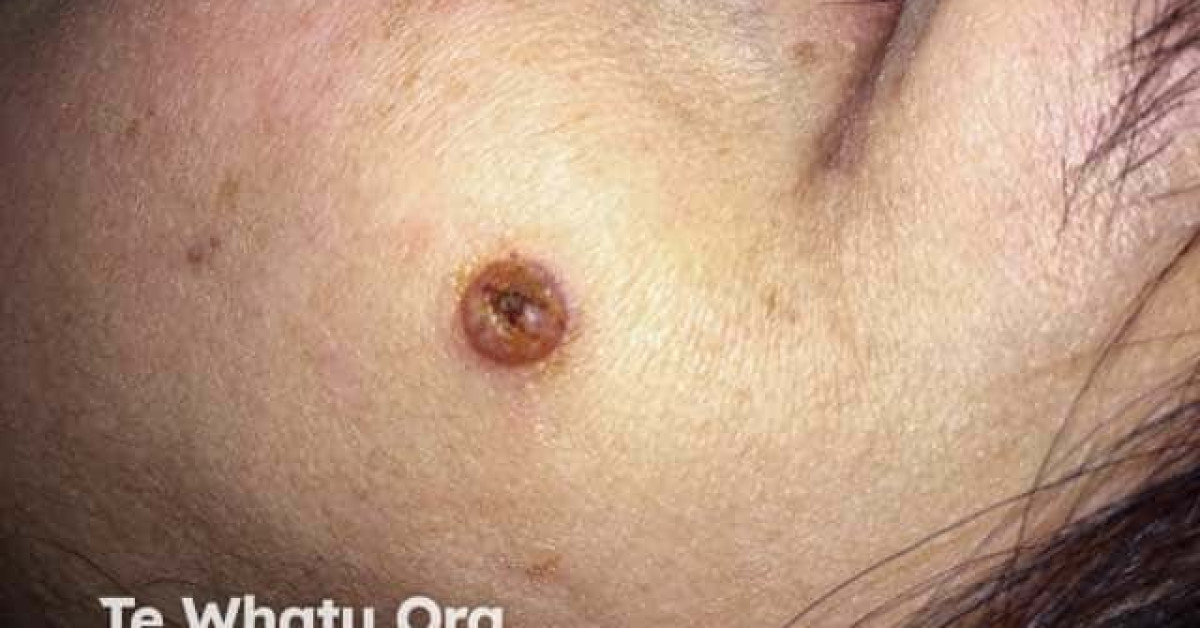 Keratoacanthoma image