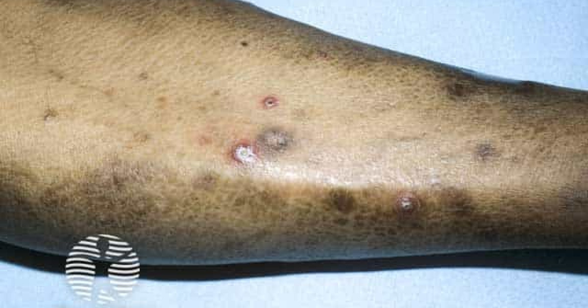 Kryle disease image