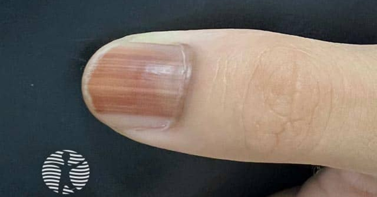 Laugier-Hunziker syndrome image