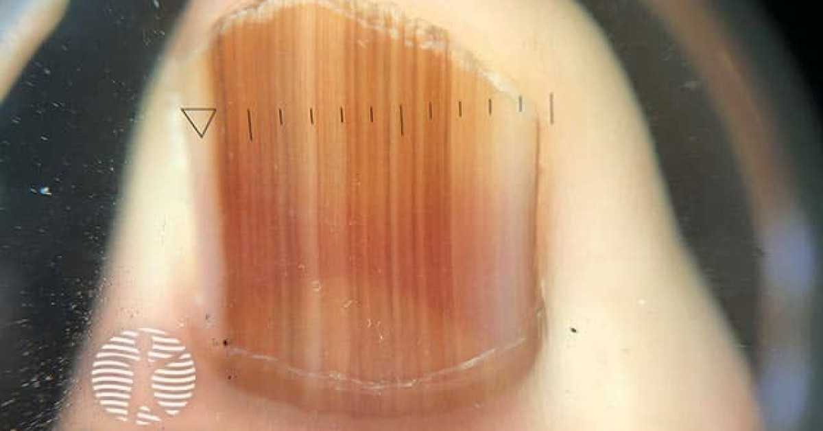 Laugier-Hunziker syndrome image