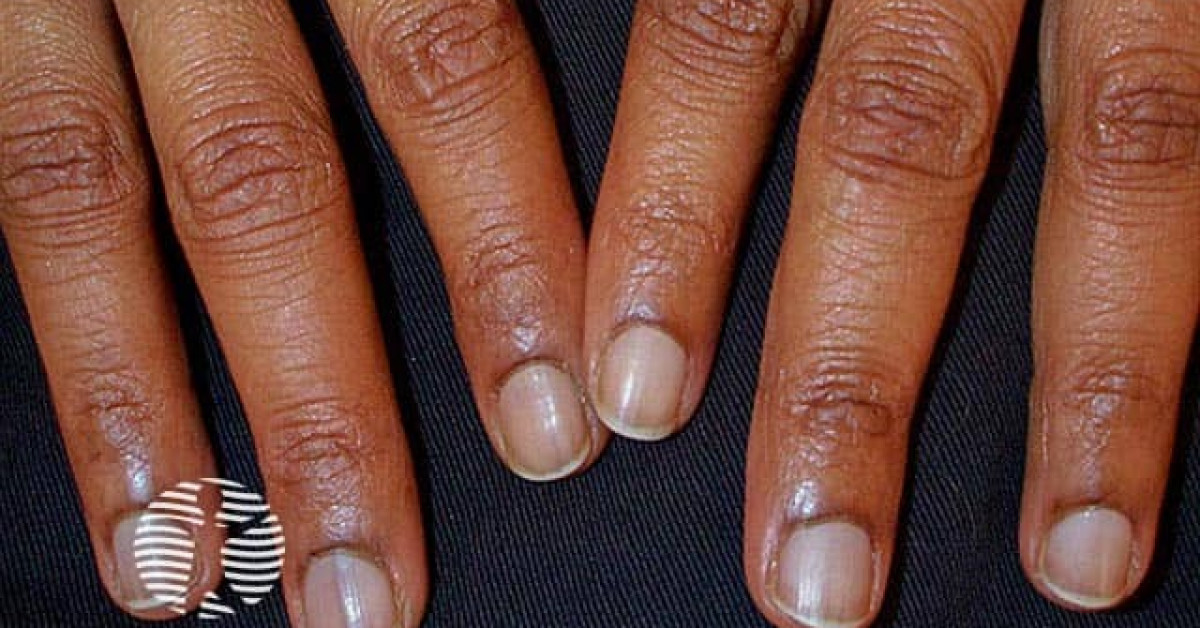 Laugier-Hunziker syndrome image