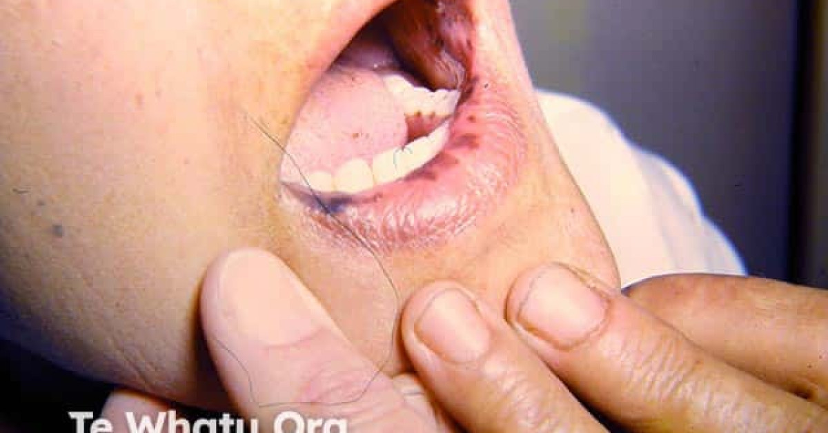 Laugier-Hunziker syndrome image