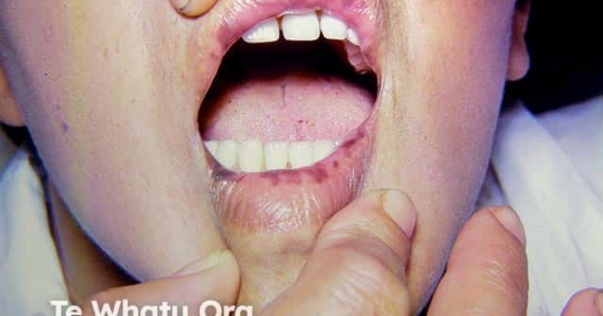 Laugier-Hunziker syndrome image