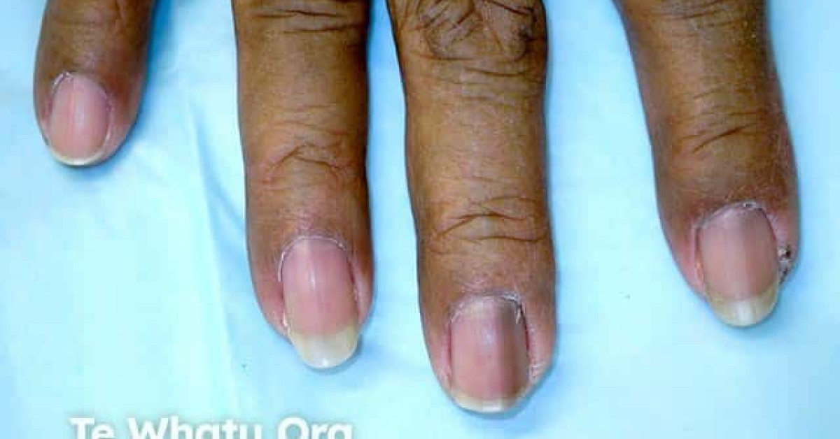 Laugier-Hunziker syndrome image