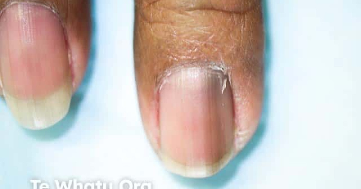 Laugier-Hunziker syndrome image