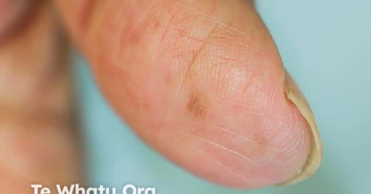 Laugier-Hunziker syndrome image