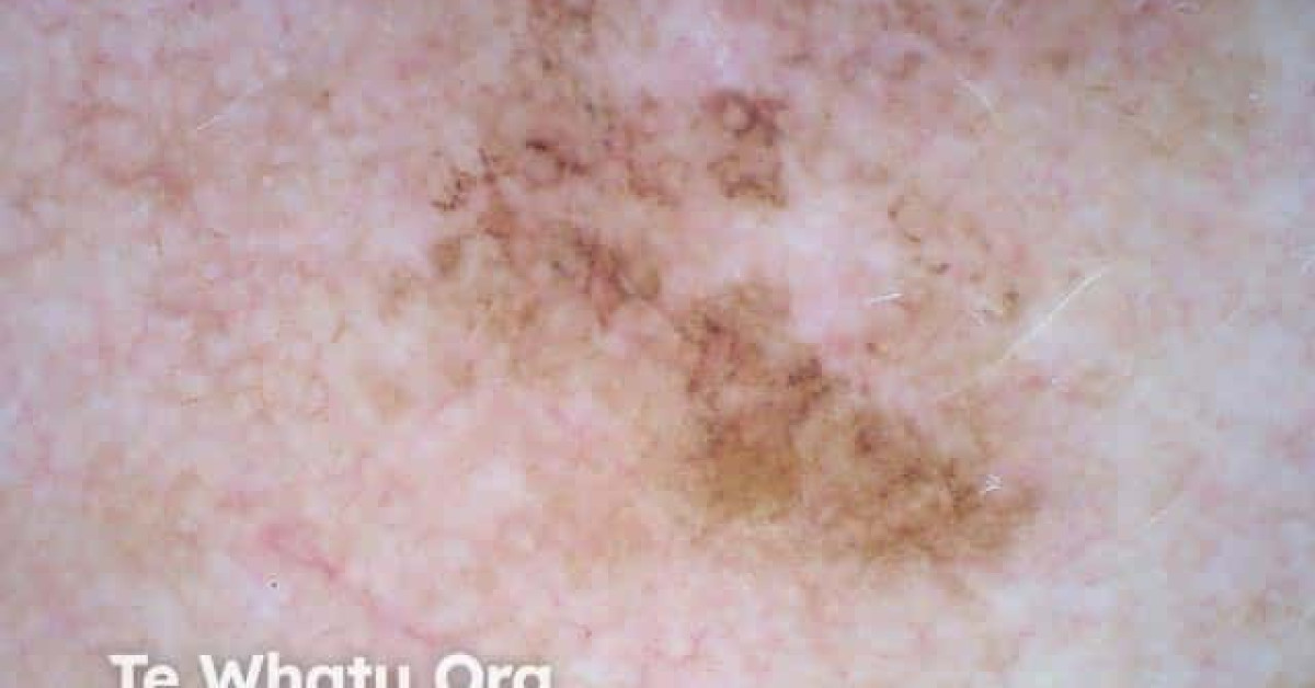 Lentigo maligna image