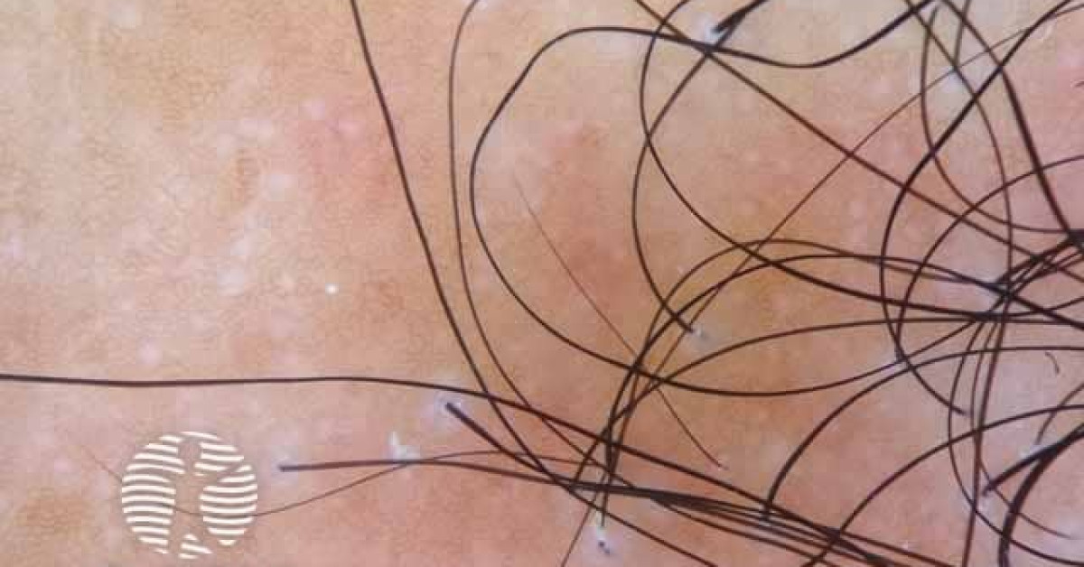 Lichen planopilaris image