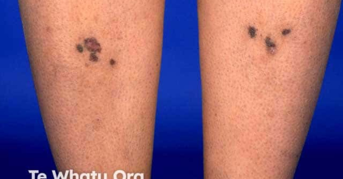 Lichen planus pigmentosus image