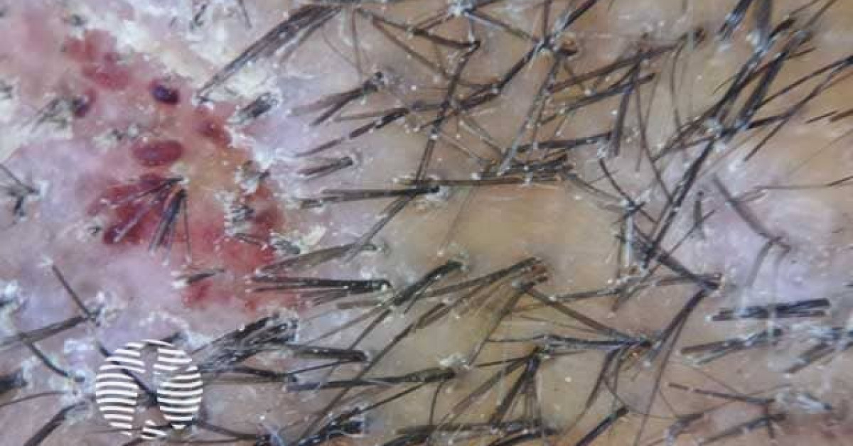 Lichen simplex image