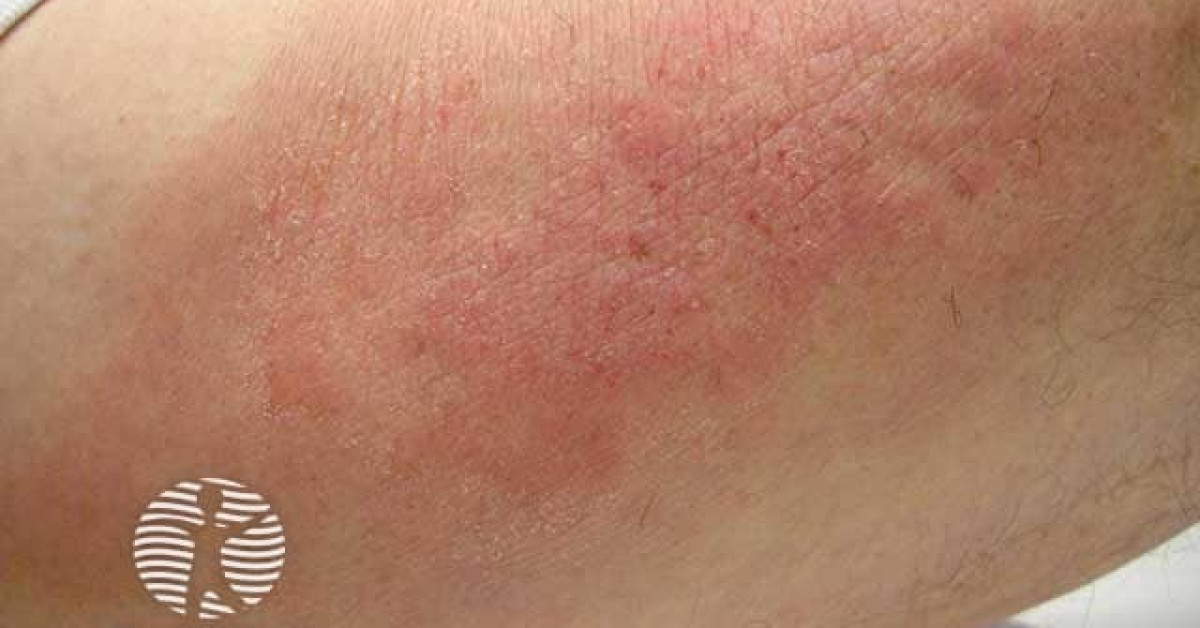 DermNet® - Lichen simplex image