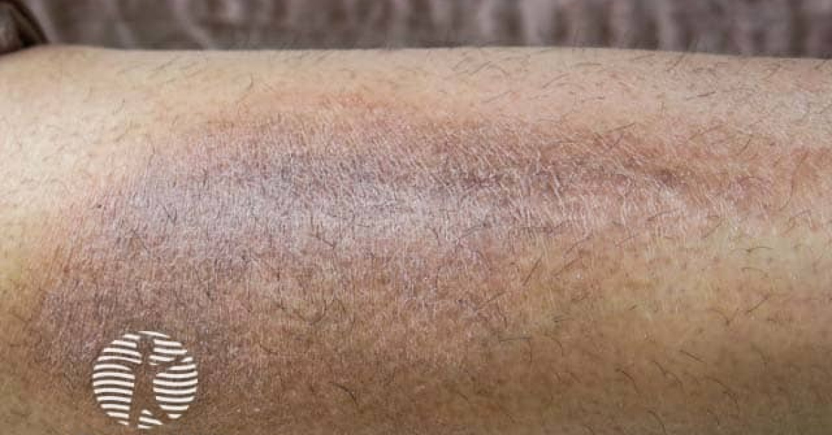 Lichen simplex image