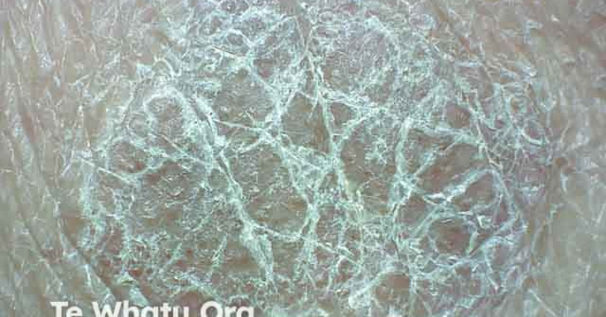 Lichen simplex image