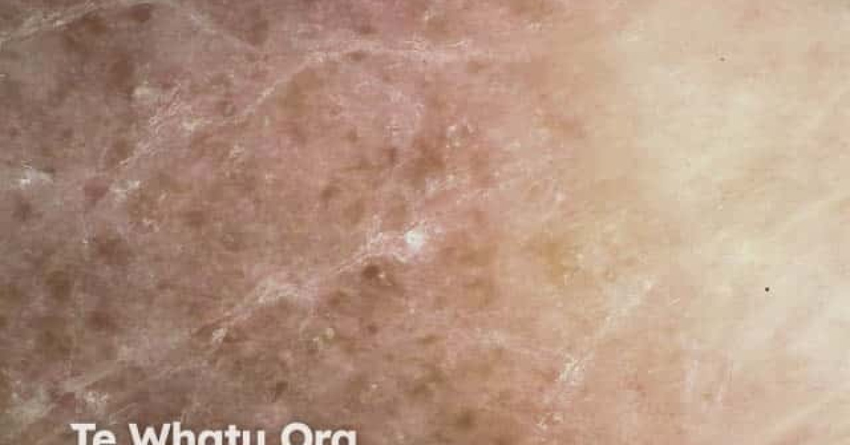 Lichen simplex image