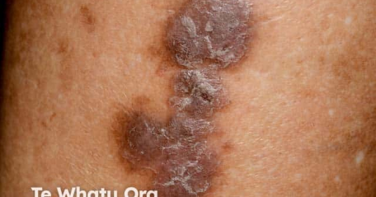 Lichen simplex image