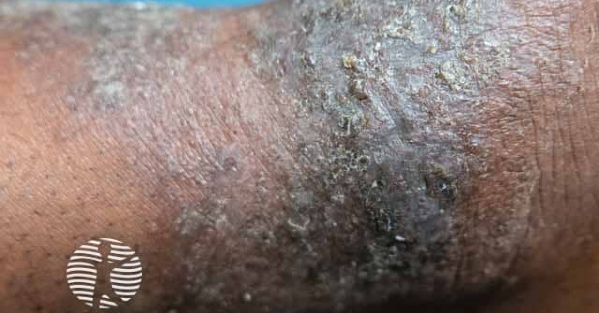 Lichen simplex image