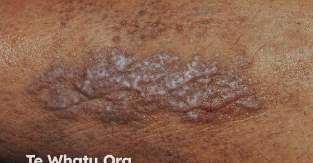 Lichen simplex image