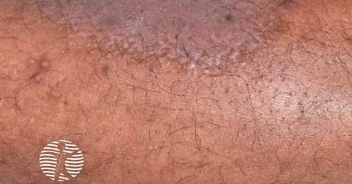 Lichen simplex image