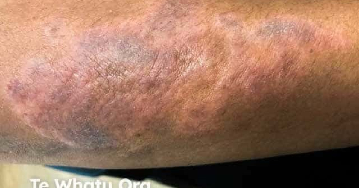 Lichen simplex image