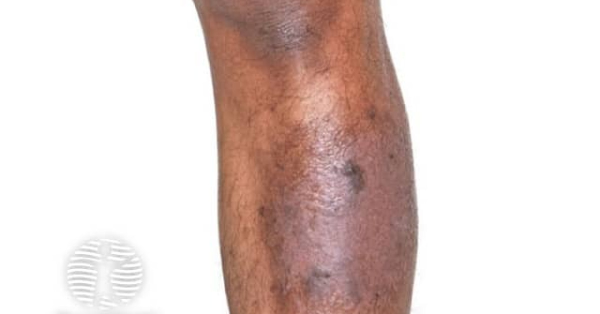 Lichen simplex image