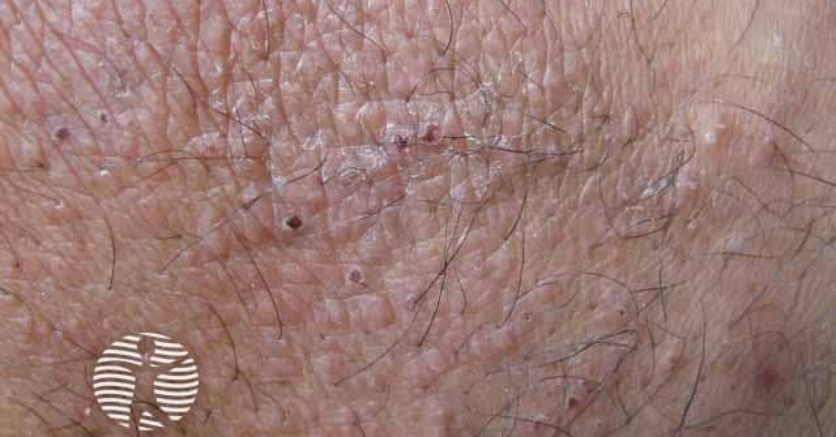 Lichen simplex image