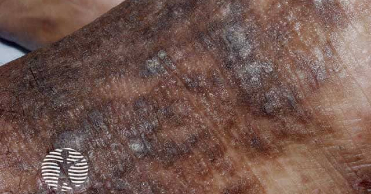 Lichen simplex image