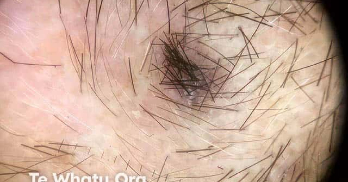 Lichen simplex image