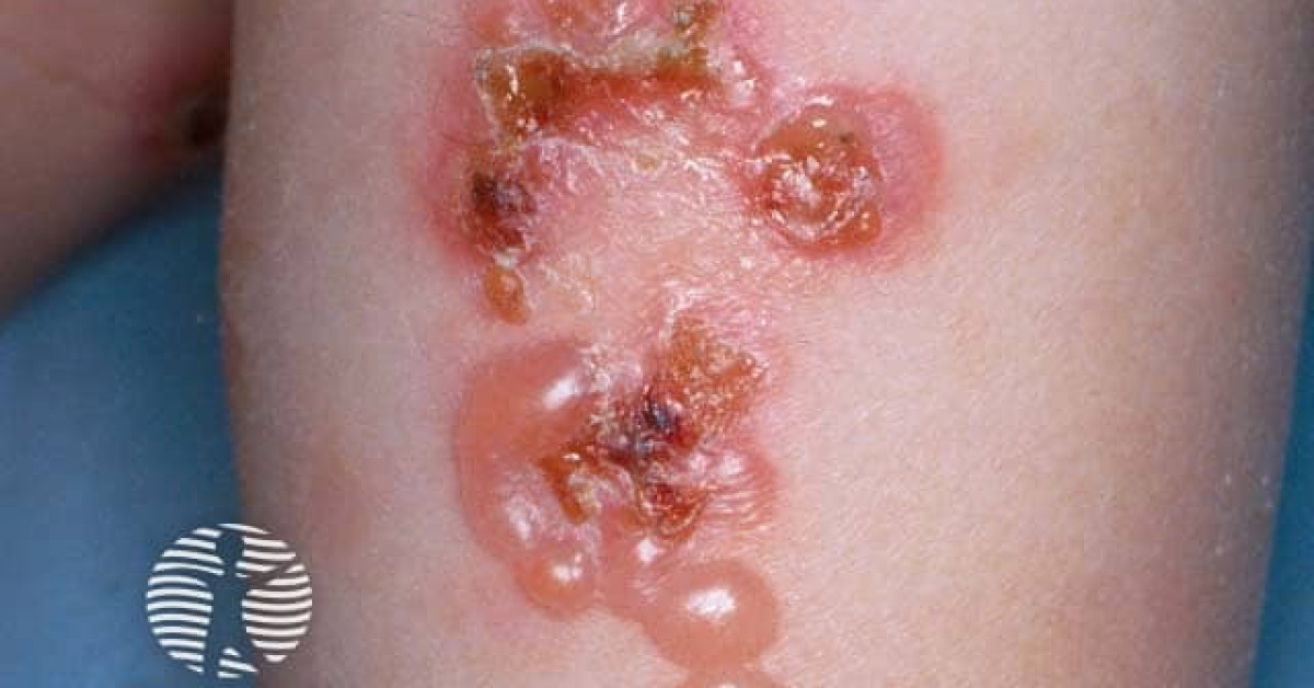 Linear IgA bullous disease image