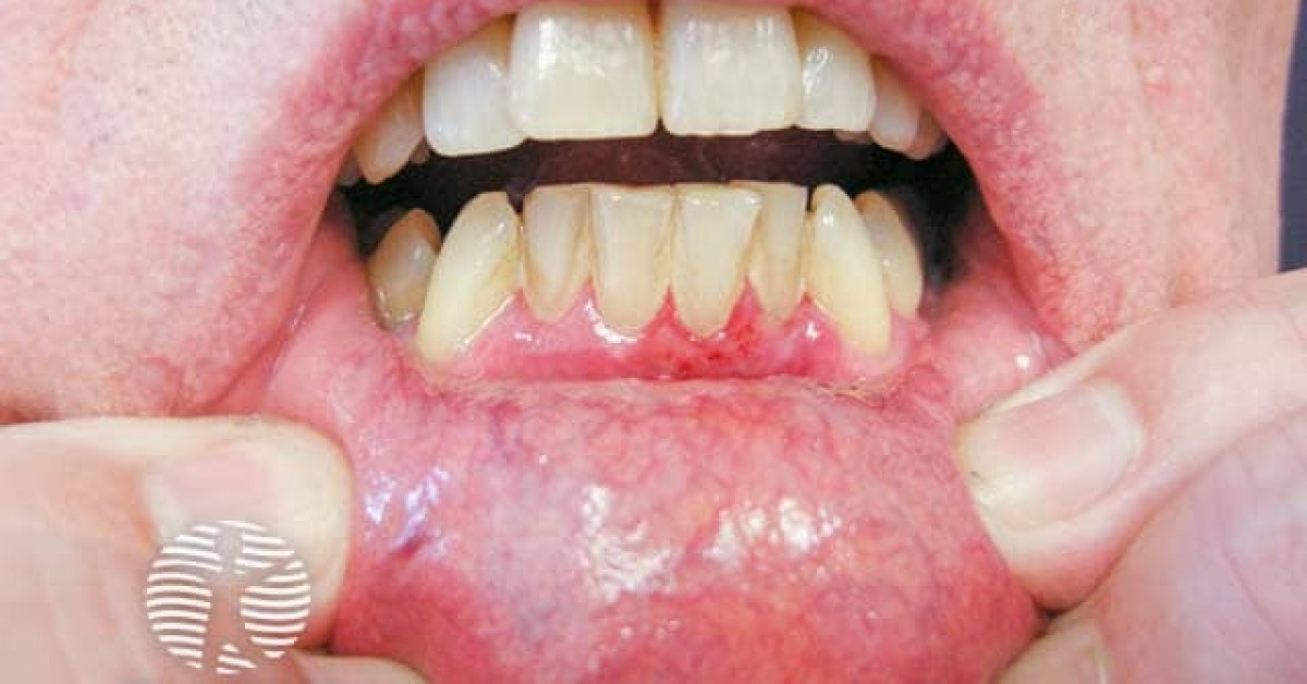 Linear IgA bullous disease image