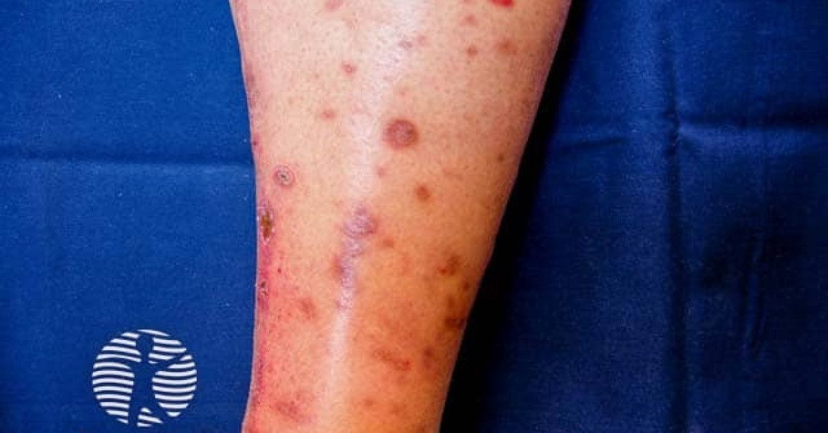 Linear IgA bullous disease image