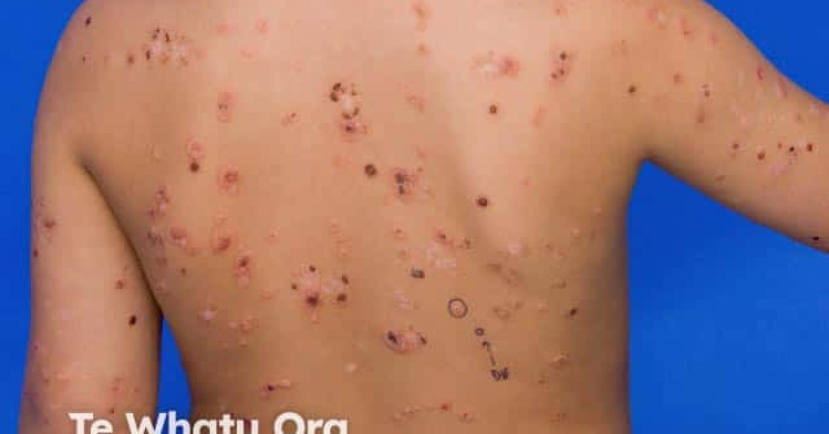 Linear IgA bullous disease image