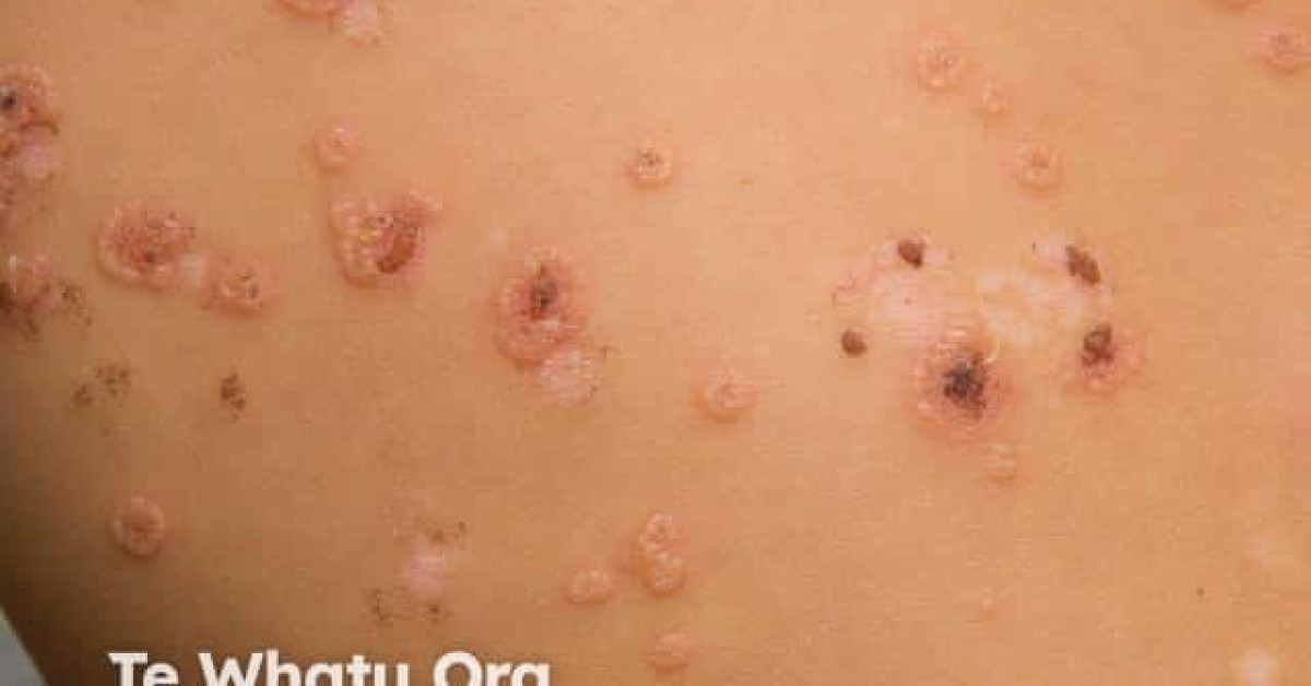 Linear IgA bullous disease image