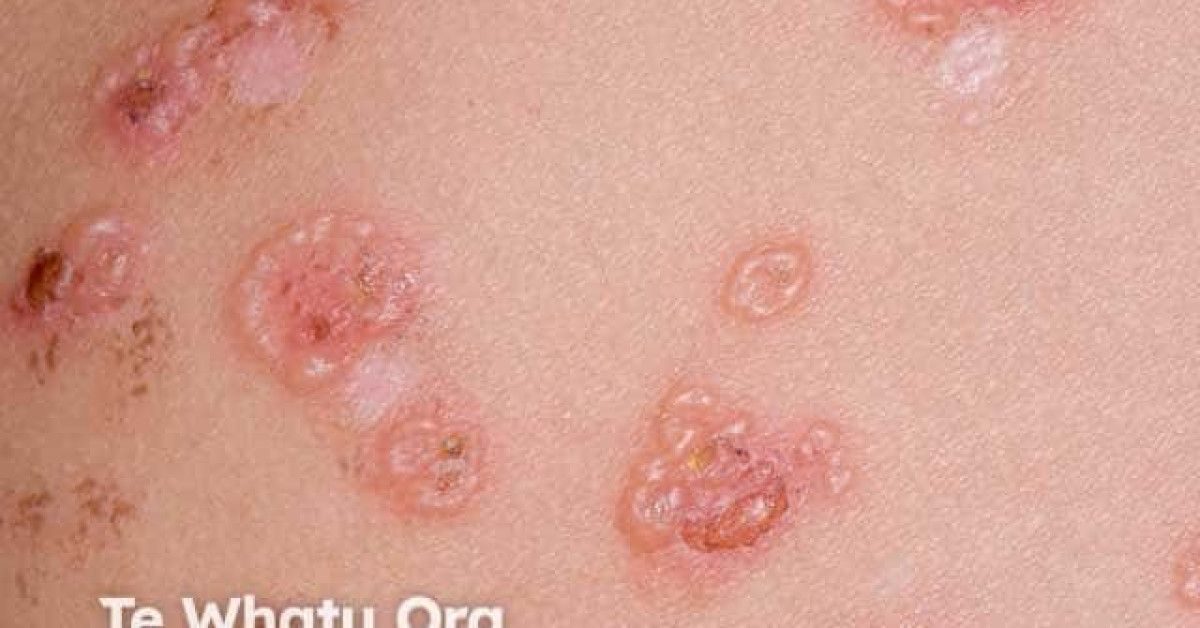 Linear IgA bullous disease image