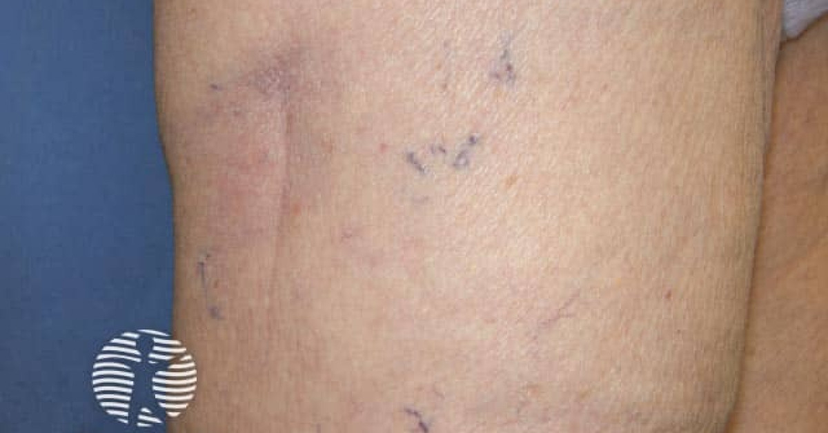 Lipodystrophy image