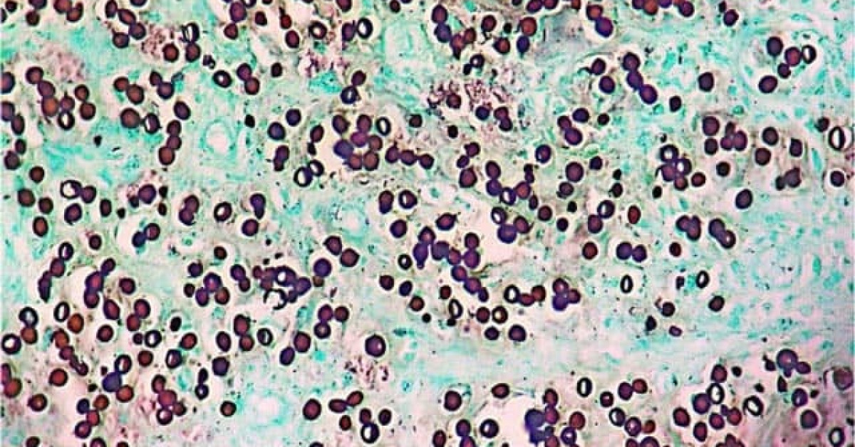 Lobomycosis image