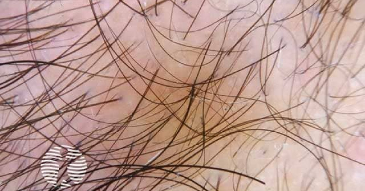 Male pattern hair loss image