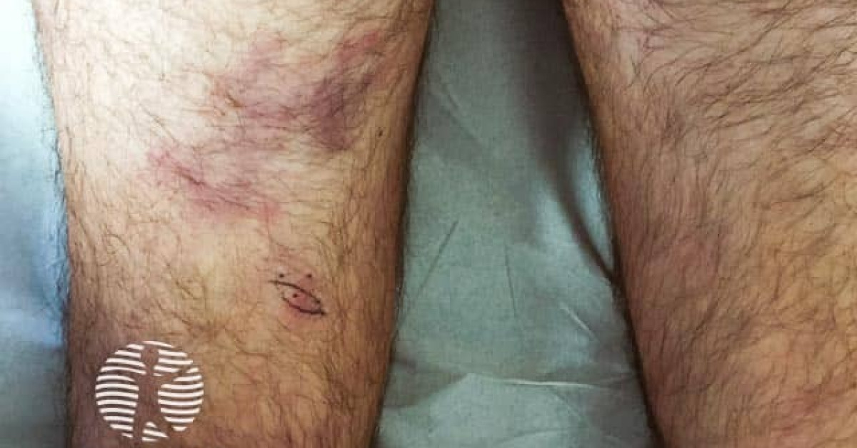 Medium vessel vasculitis image