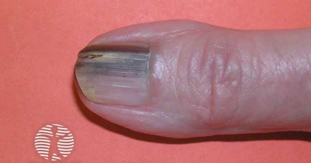 Melanoma of the nail unit image