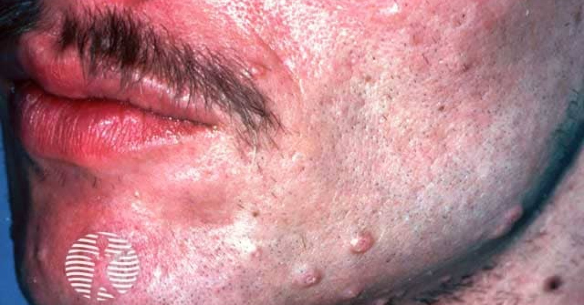 Molluscum contagiosum image