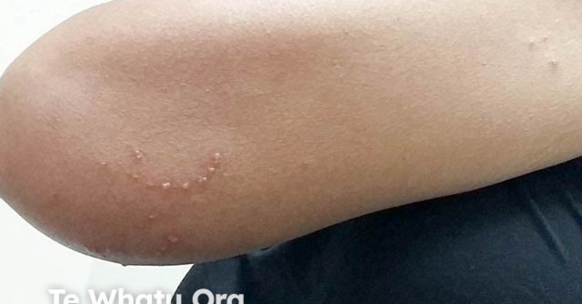 Molluscum contagiosum image