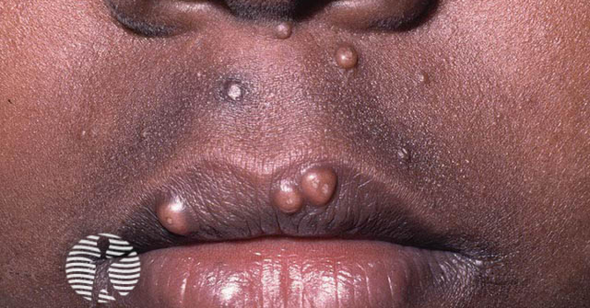 Molluscum contagiosum image