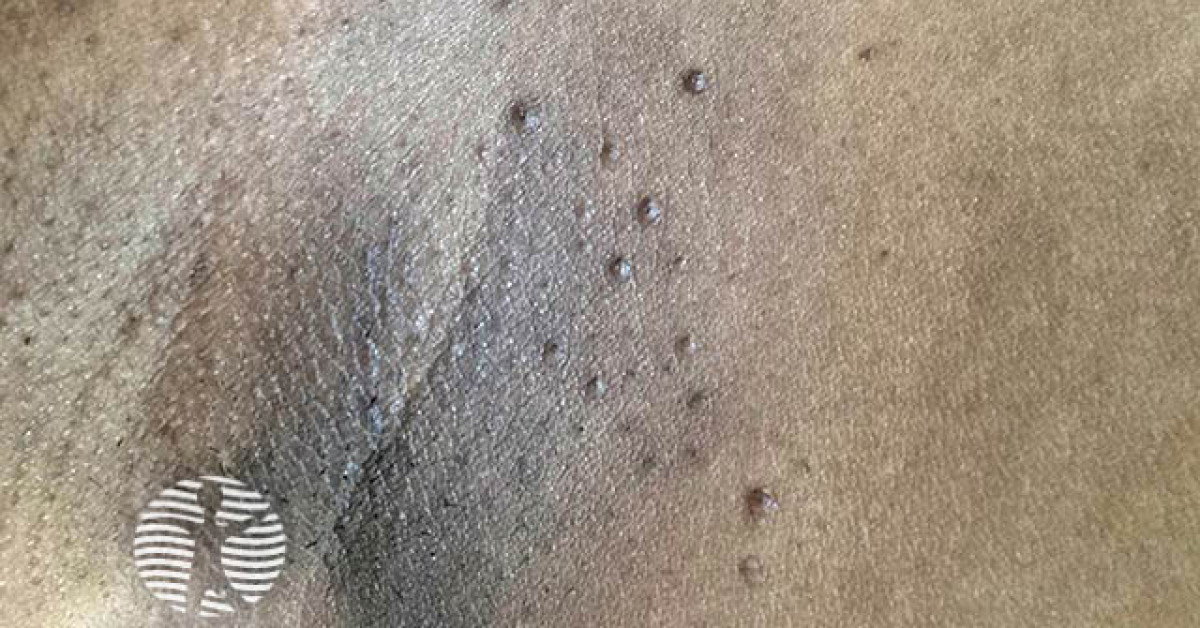 Molluscum contagiosum image